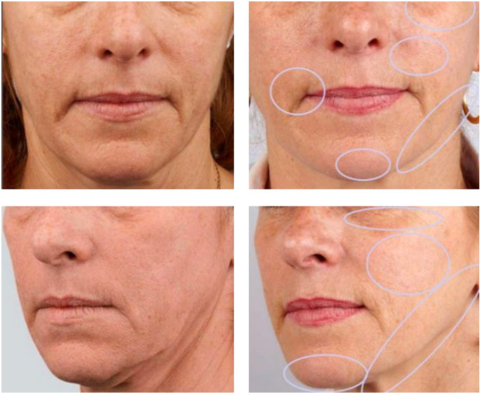 Redensity 1 Skin Booster - Avenir