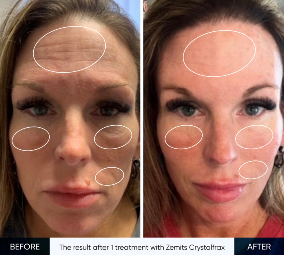 Fractional Radio Frequency Skin Tightening Treatment - Avenir